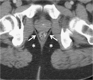 CT of acute perianal abscesses and infected fistulae: a pictorial essay ...