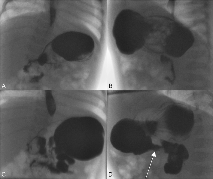 Imaging findings in infants with recurrent vomiting after pyloromyotomy ...