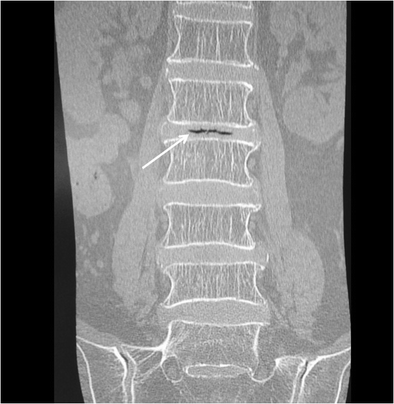 Vacuum phenomenon | SpringerLink