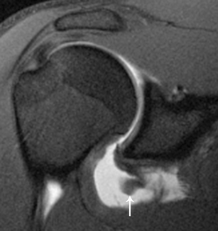 Inferior glenohumeral ligament (IGHL) complex: anatomy, injuries ...