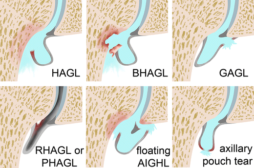 Inferior glenohumeral ligament (IGHL) complex: anatomy, injuries ...