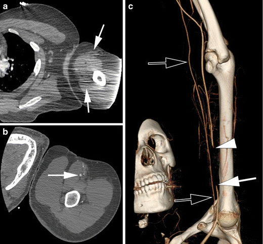 Extremity CTA for penetrating trauma: 10-year experience using a 64 ...