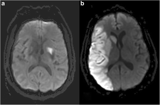 Beyond stroke—uncommon causes of diffusion restriction in the basal ...