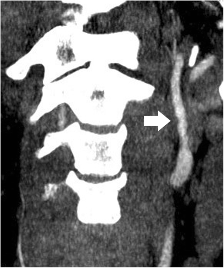 Augmenting Denver criteria yields increased BCVI detection, with ...