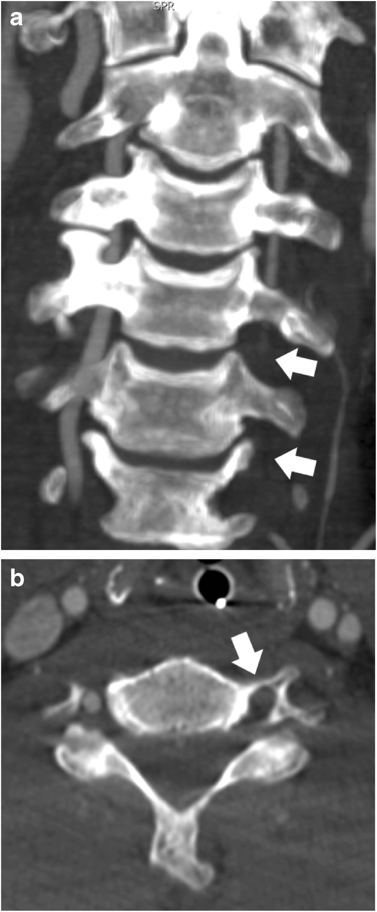 Augmenting Denver criteria yields increased BCVI detection, with ...