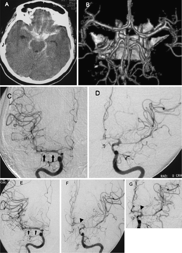 Management of cerebral vasospasm | SpringerLink