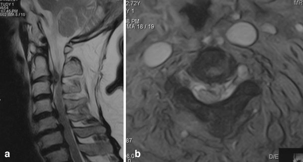 Anterolateral extradural approach for C2–C3 disc herniation: technical ...