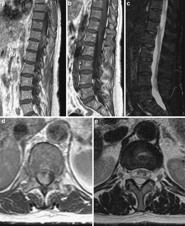 Intramedullary lesions of the conus medullaris: differential diagnosis ...
