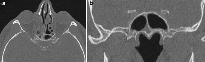Pneumatization degree of the anterior clinoid process: a new ...