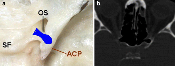 Pneumatization degree of the anterior clinoid process: a new ...