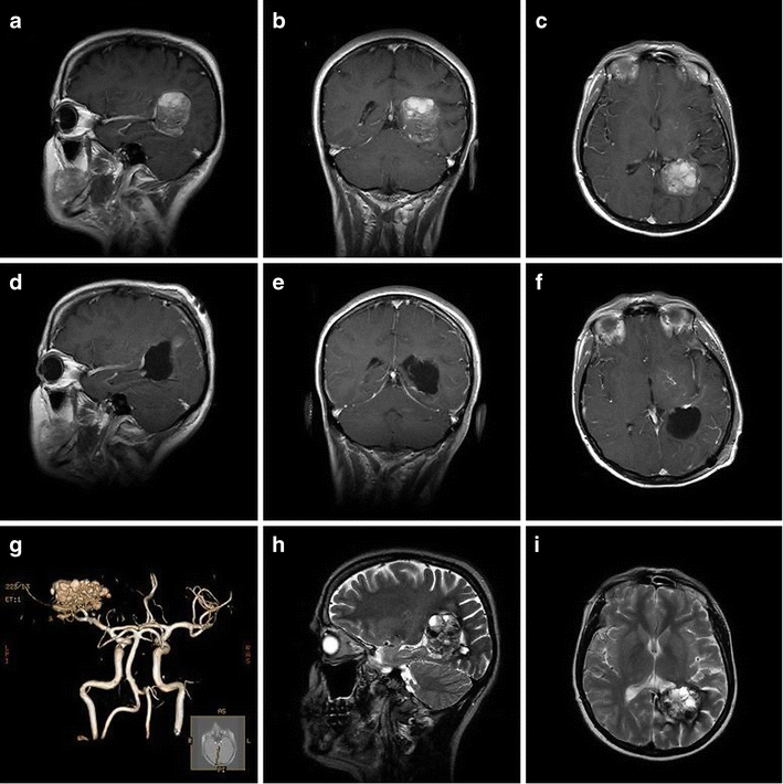 Trigonal and peritrigonal lesions of the lateral ventricle—surgical ...