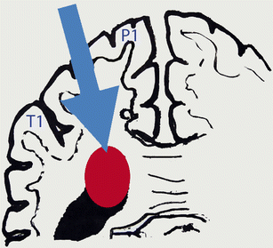 Trigonal and peritrigonal lesions of the lateral ventricle—surgical ...