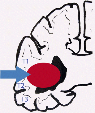 Trigonal and peritrigonal lesions of the lateral ventricle—surgical ...