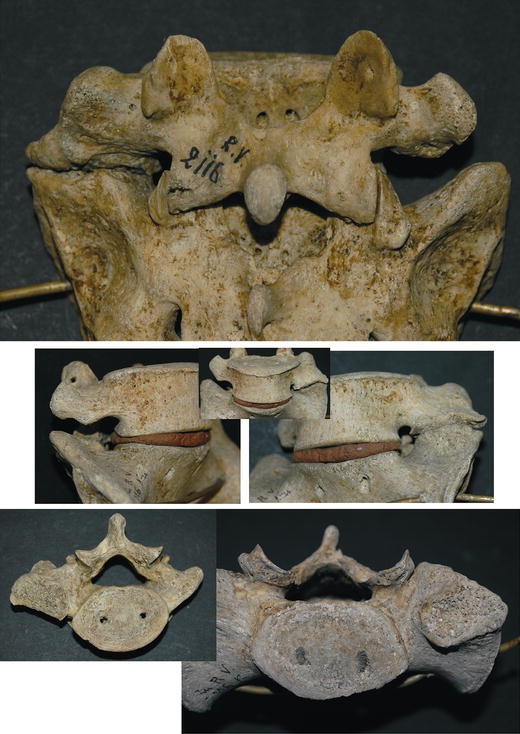 Transitional lumbosacral segment with unilateral transverse process ...