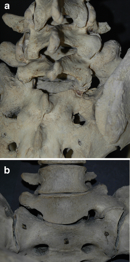 Transitional lumbosacral segment with unilateral transverse process ...
