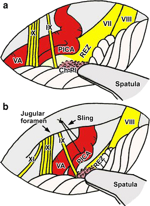 Stitched sling retraction technique for microvascular decompression ...