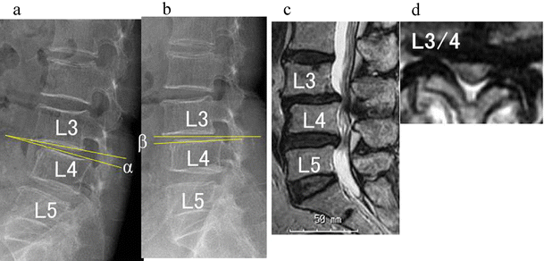 Spinous process plate (S-plate) fixation after posterior interbody ...