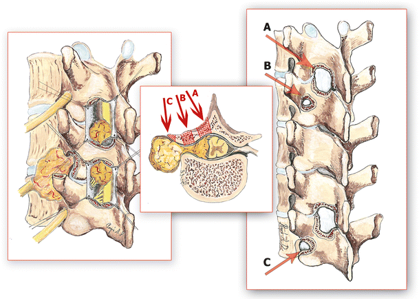 Minimally invasive spine surgery: systematic review | SpringerLink