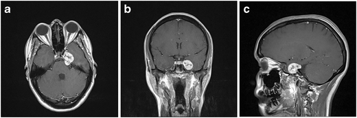 Fourth cranial nerve: surgical anatomy in the subtemporal ...