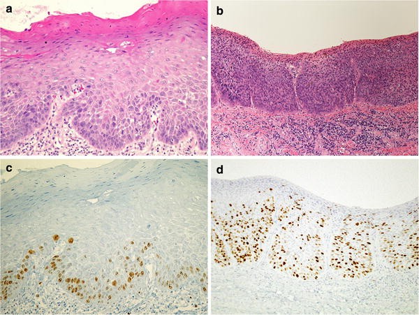 Oral premalignant lesions: from the pathological viewpoint | SpringerLink