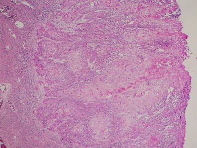 A case of usual (basaloid)-type vulvar intraepithelial neoplasia that ...