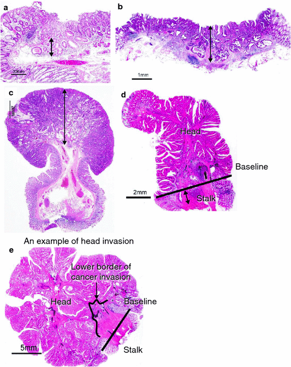Japanese Society for Cancer of the Colon and Rectum (JSCCR) guidelines ...