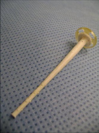 Ileal pouch-vaginal fistula: treatment with the new Surgisis® Biodesign ...