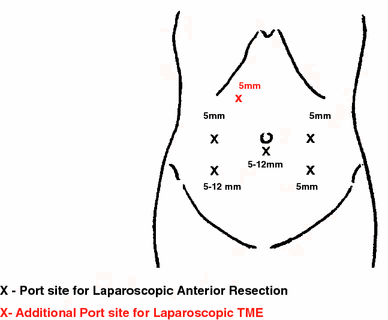 Laparoscopic anterior resection | SpringerLink