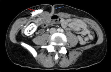 Malone appendicostomy: an unexpected complication | SpringerLink