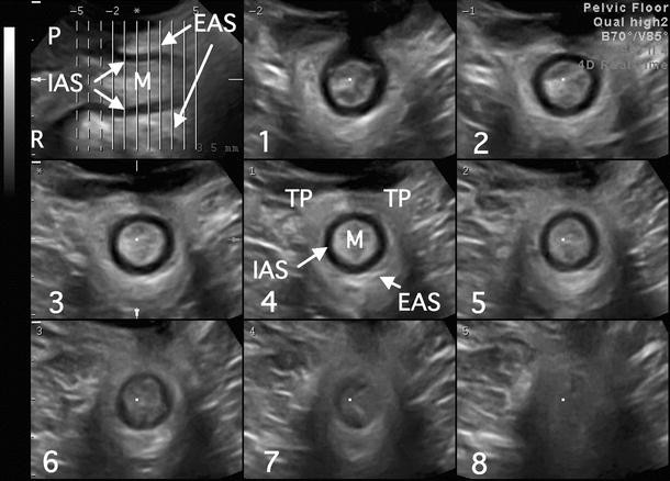 Translabial ultrasound in the assessment of pelvic floor and anorectal ...