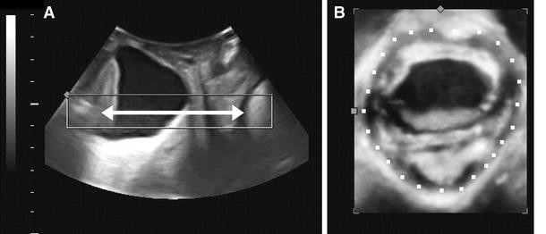 Translabial ultrasound in the assessment of pelvic floor and anorectal ...