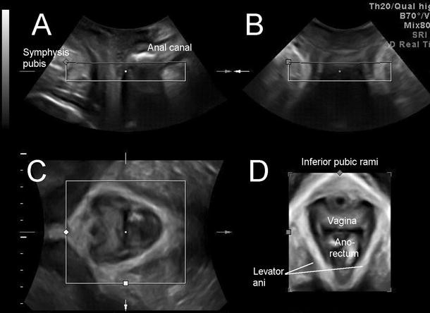 Translabial ultrasound in the assessment of pelvic floor and anorectal ...