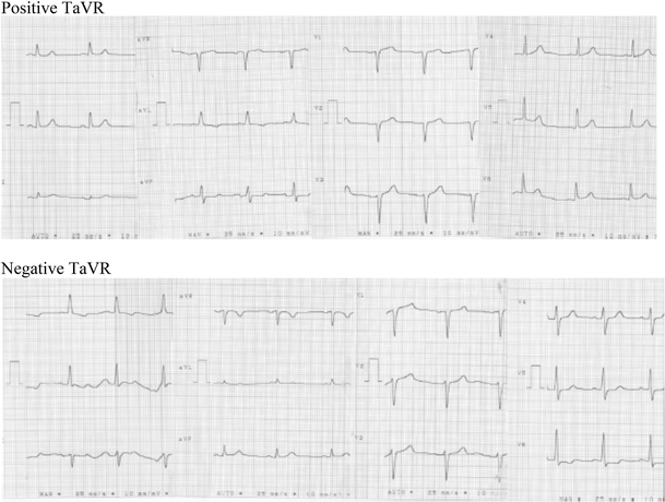 The prognostic value of positive T-wave in lead aVR in hemodialysis ...