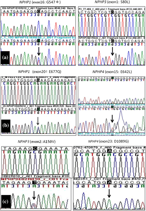 Clinical and genetic characteristics of Japanese nephronophthisis ...