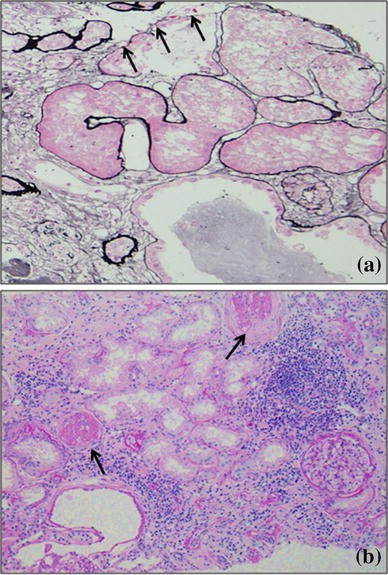 Clinical and genetic characteristics of Japanese nephronophthisis ...