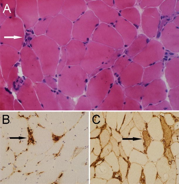 Statin-associated necrotizing autoimmune myopathy | SpringerLink