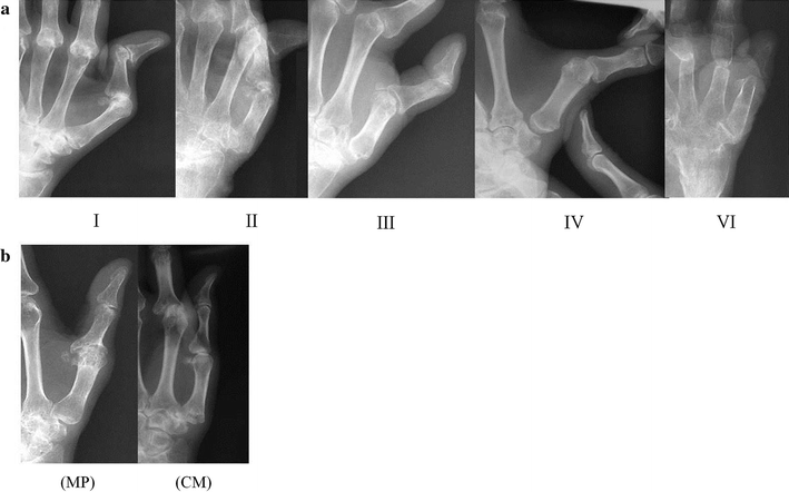 Rheumatoid arthritis of the hand: a five-year longitudinal analysis of ...