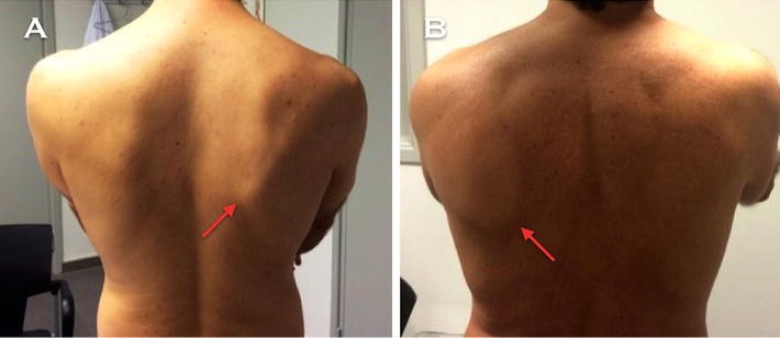 Management of chronic unstable acromioclavicular joint injuries ...