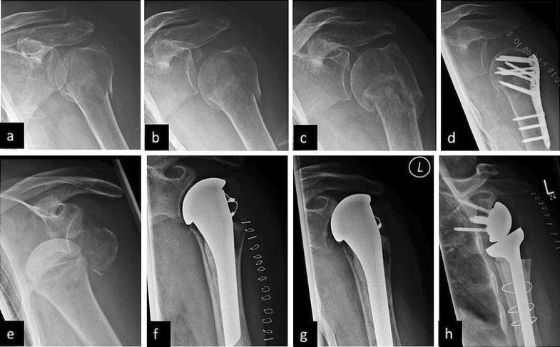 Failure and revision rates of proximal humeral fracture treatment with ...