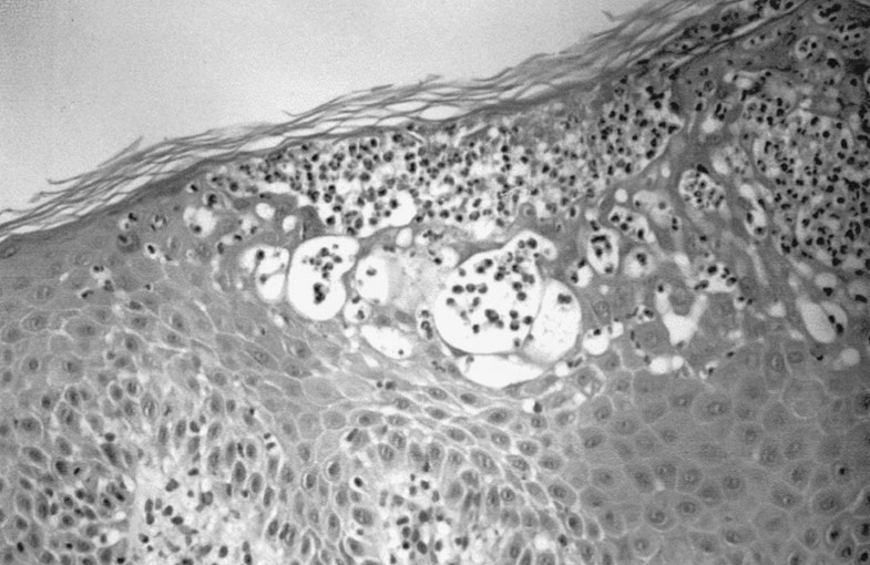 Pyodermatitis–Pyostomatitis Vegetans: Two Cases and a Review of the ...