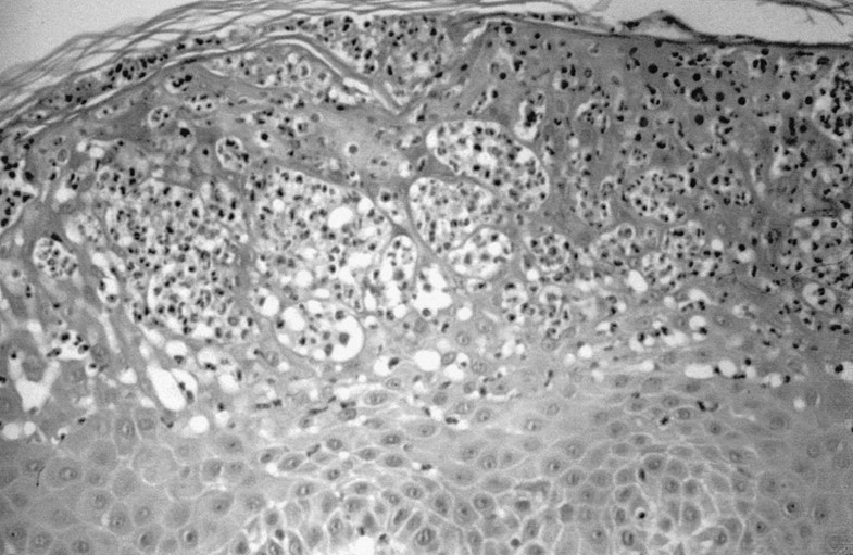 Pyodermatitis–Pyostomatitis Vegetans: Two Cases and a Review of the ...