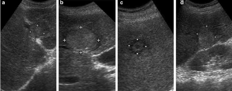 Characterization of Primary and Secondary Malignant Liver Lesions from ...