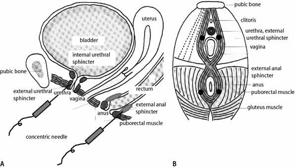 Sphincter EMG as a diagnostic tool in autonomic disorders | SpringerLink