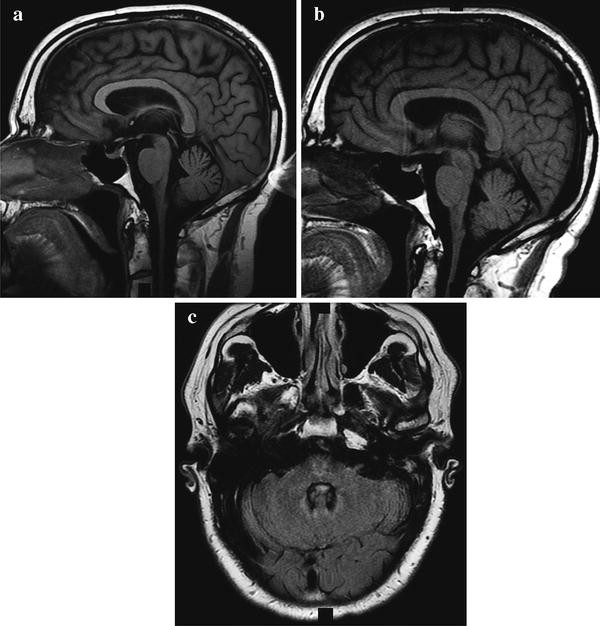Autonomic dysfunction in adult-onset alexander disease | SpringerLink