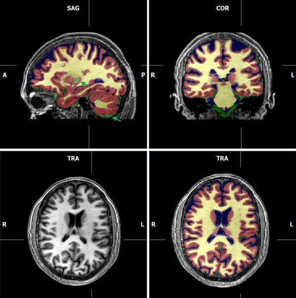 Segmentation of human brain using structural MRI | SpringerLink