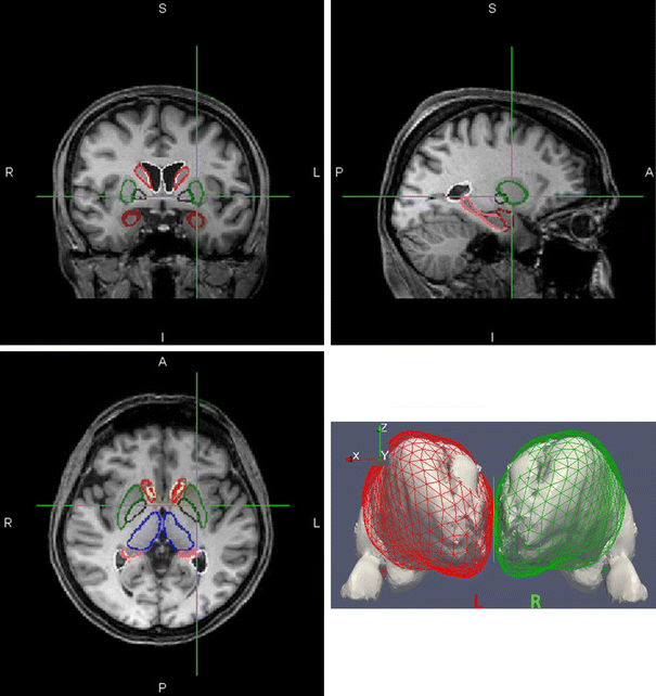 Segmentation of human brain using structural MRI | SpringerLink