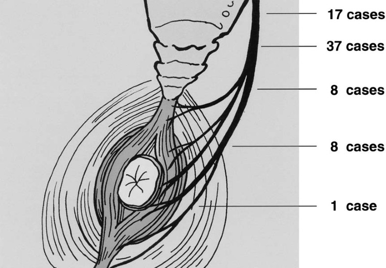 Proctalgia Fugax: Caused By Pudendal Neuropathy? | SpringerLink