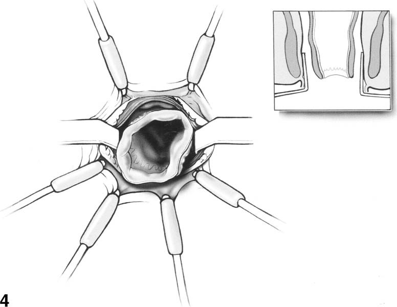 Technique and Long-Term Results of Intersphincteric Resection for Low ...