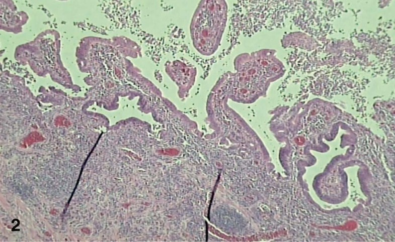 Ileitis in Ulcerative Colitis: Is It a Backwash? | SpringerLink