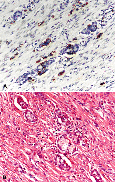 Goblet Cell Carcinoid Tumors (Adenocarcinoid) of the Appendix ...
